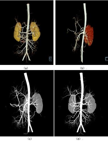 肝脏一体化成像（一次一体化扫描成像：肝脏平扫及增强、肝动脉 CTA、 门脉 CTAP、3D 可视化） － 丁香园
